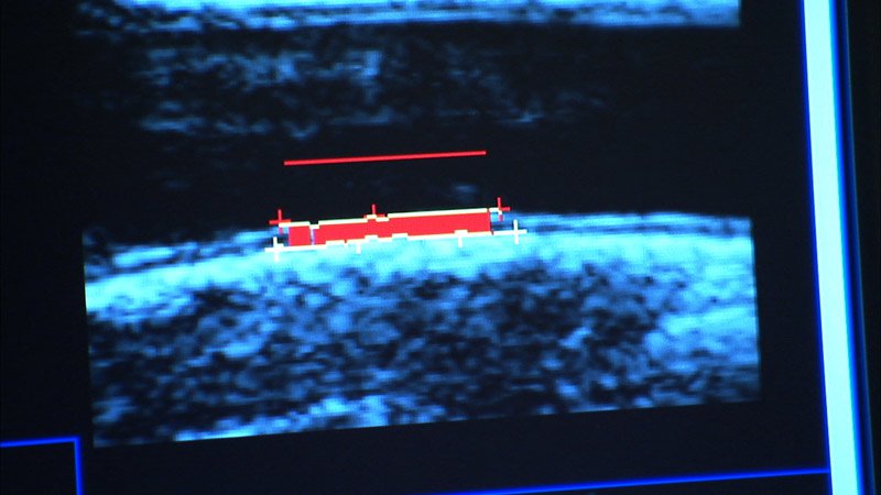 NASA Technology Helps Detect and Treat Heart Disease and Strokes | NASA ...